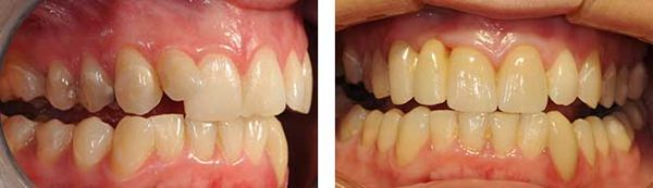 Full Bite Reconstruction - Partial Bite Reconstruction - Dr. Florian Mack