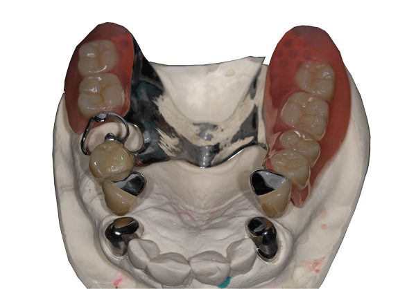 Telescopic Dentures - German Technology - Brisbane - Gold Coast